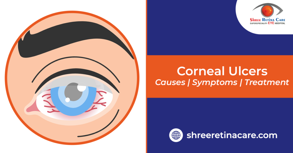 Corneal Ulcers, Causes, Symptoms, and Treatment