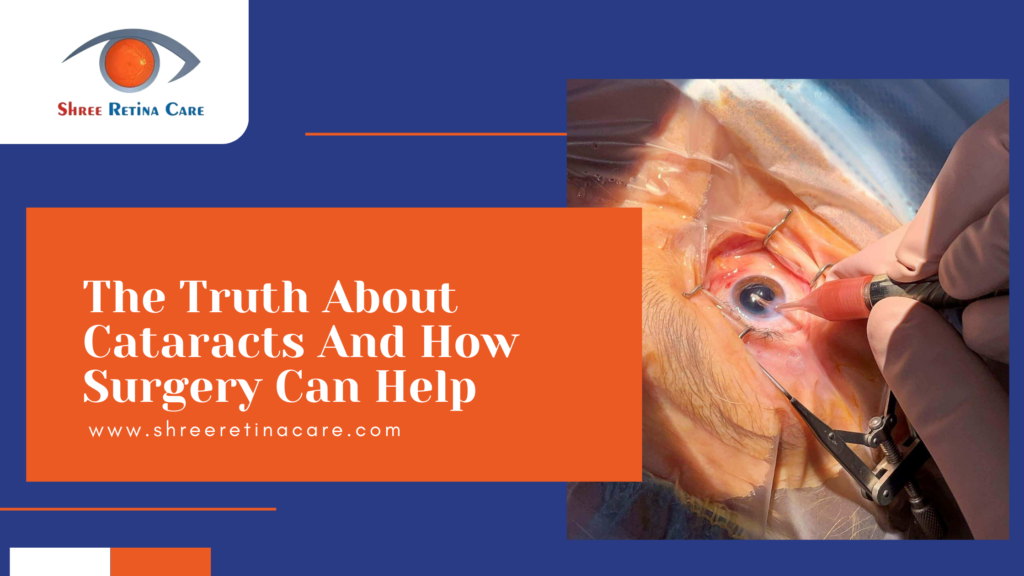 The Truth About Cataracts And How Surgery Can Help